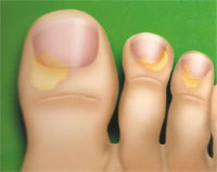 Podóloga Patricia Brayner: O que é Paroníquia???