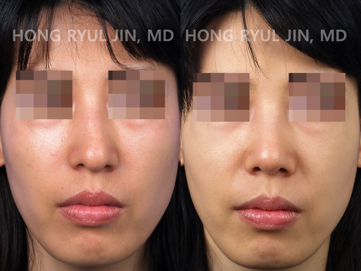 Deviated nose and chin