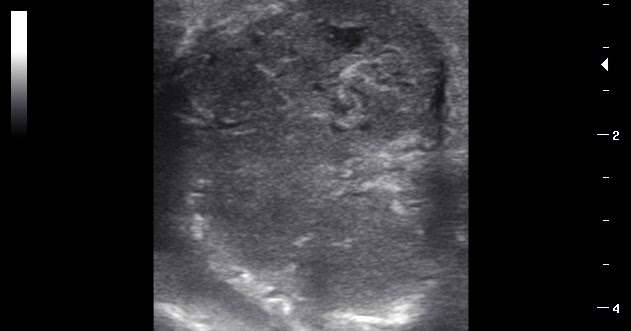 Tuberculosis Testicular