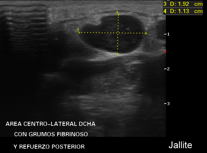 Abscesos Submentonianos