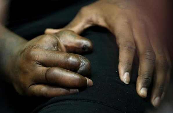 Here's a First Look at Jason Pierre-Paul’s Mangled Hand (Photos ...