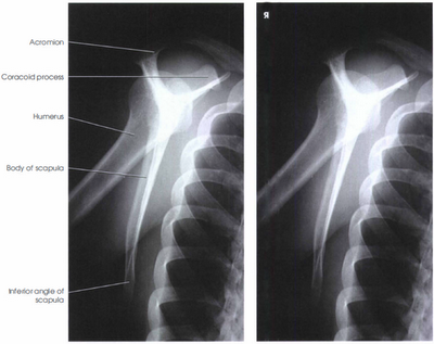 LATERAL PROJECTION - RAO OR LAO: SCAPULA - RadTechOnDuty
