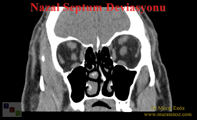 How Can You Understand The "Nasal Septum Deviation" In Your Nose?