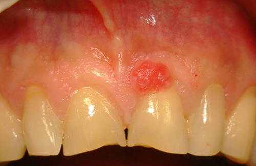Lesiones bucales inflamatorias localizadas no infecciosas - Odontología ...