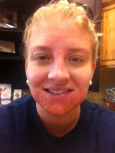 Jessica Mae: Melaleuca Oil Skin Burn