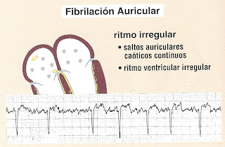 Electrocardiograma: Fibrilación auricular