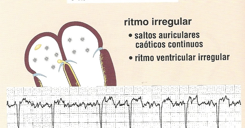 Electrocardiograma: Fibrilación auricular