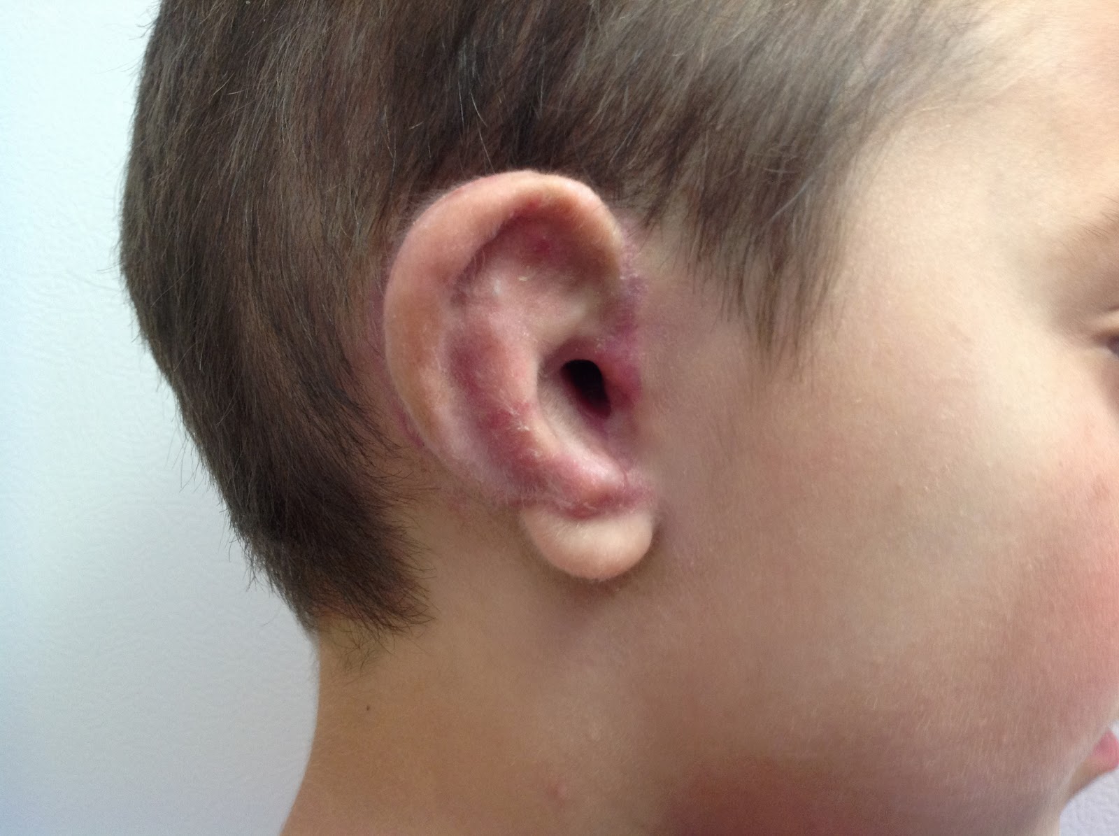 Microtia: Microtia Rib Cartliage Ear Surgery done in only ONE surgery!