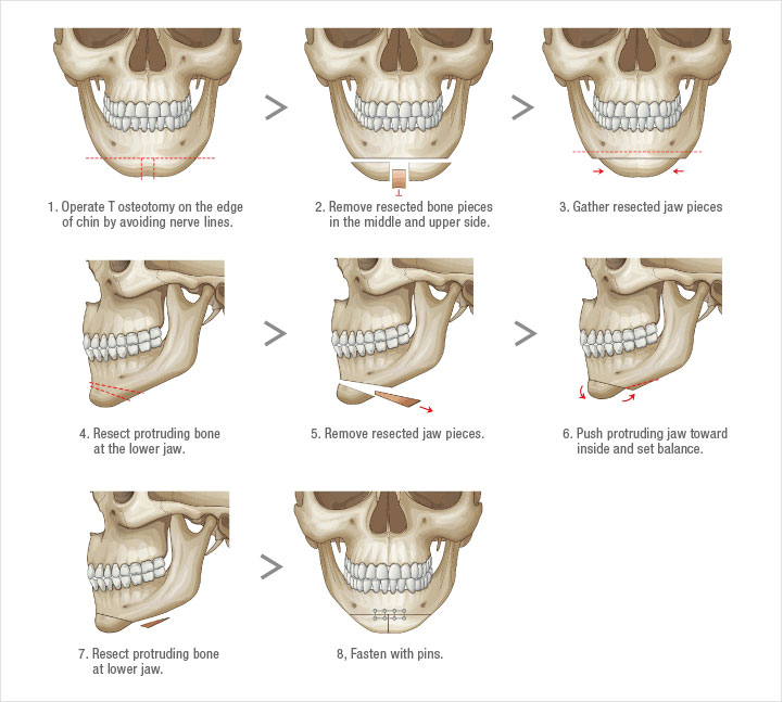 ID Hospital Korea: Mini V-Line, ID Plastic Surgery Hospital Korea