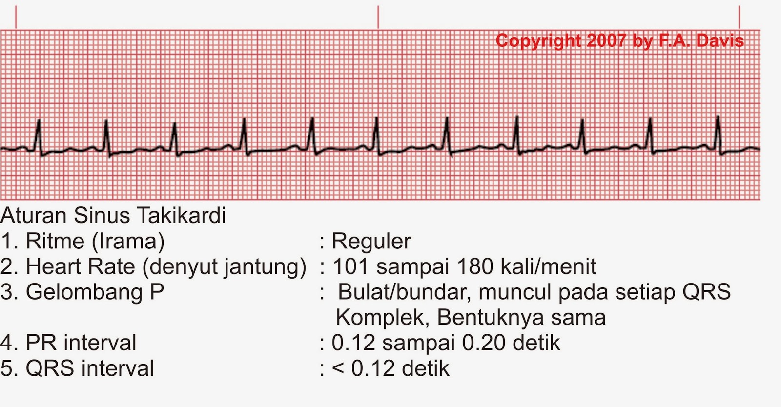 Sinus Arrest (Henti Sinus)