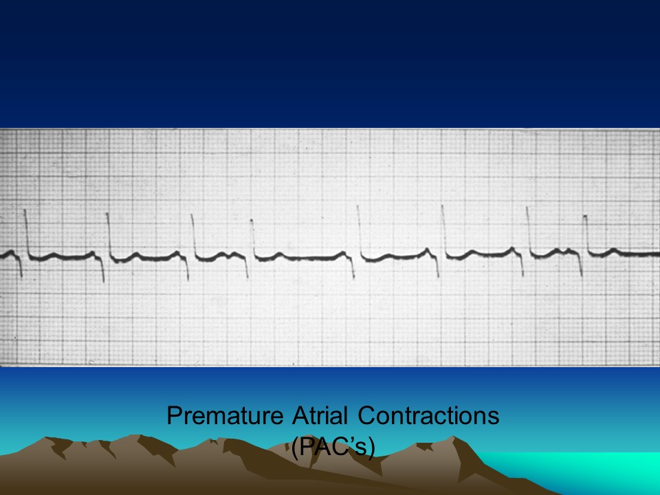 CVT Mohd Farid: Electrocardiogram ECG Part III Basic ECG Rhythm Pattern ...