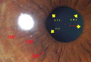 Modern & Multidimensional Iridology: Pupil Applanations, Schwalbe's ...