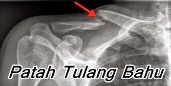 Kesan Jangka Panjang Tulang Patah Selepas Kemalangan Jalan Raya ...