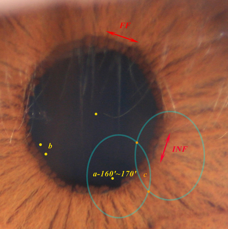 Modern & Multidimensional Iridology: Important Iris Signs at IPB, Pupil ...