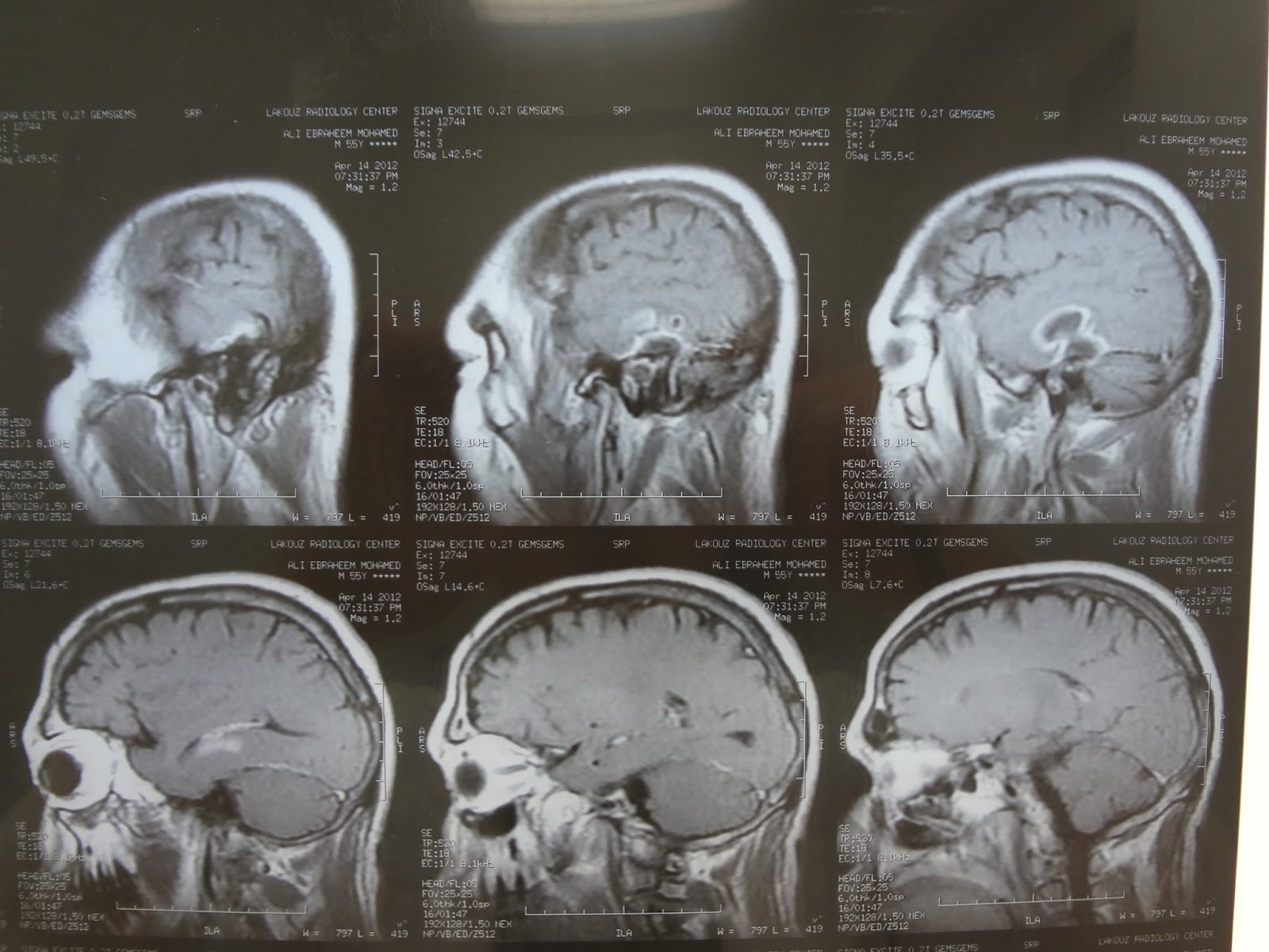 lt temporal lobe abscess complicating attico antral cholesteatoma MRI ...