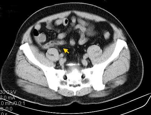 O Radiologista: Apendicite - Ultrassom e Tomografia