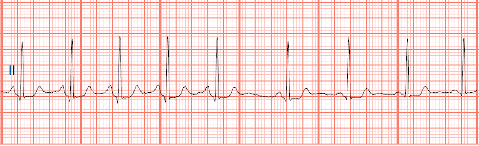 Basic EKG Rhythm Test 45