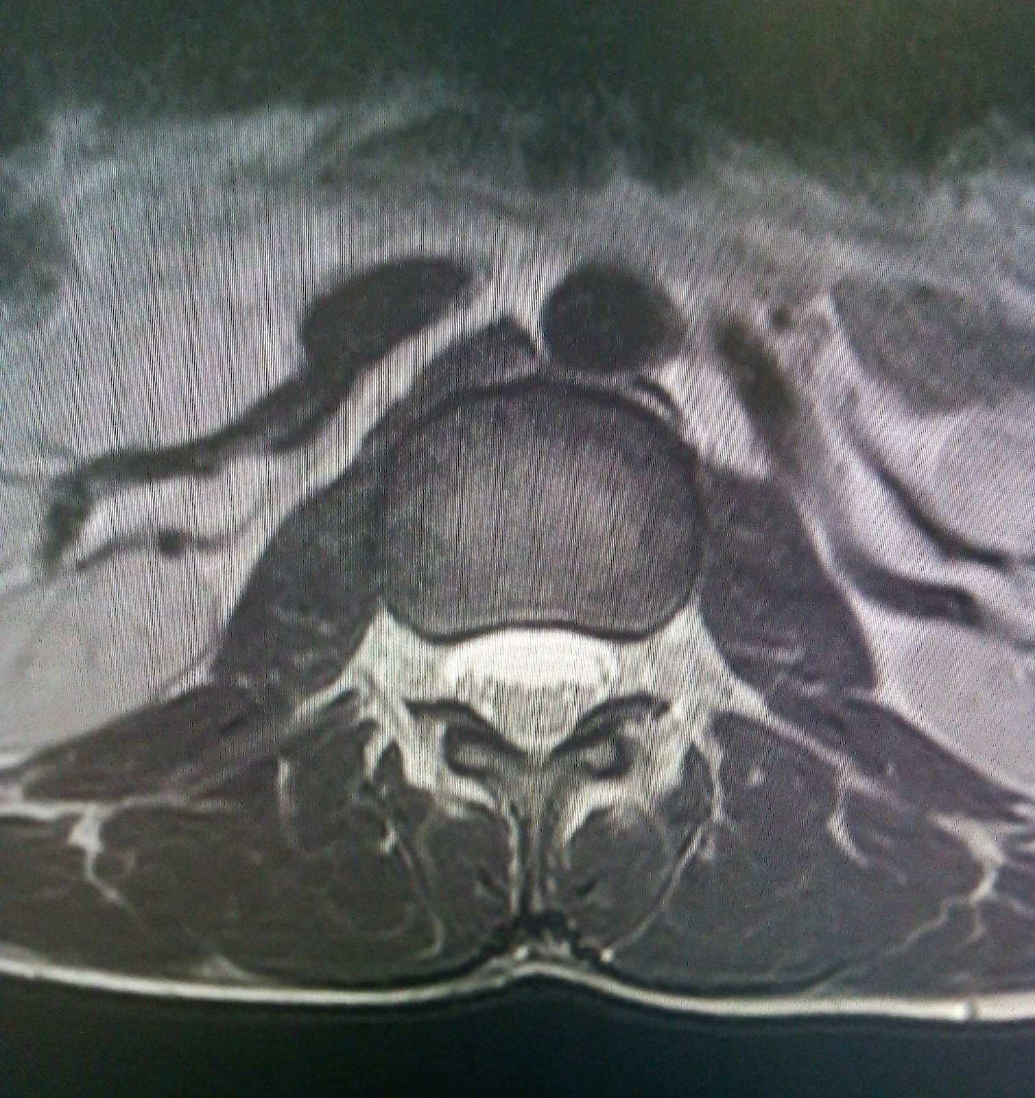 Chronic inflammatory demyelinating polyradiculoneuropathy (CIDP): MRI ...