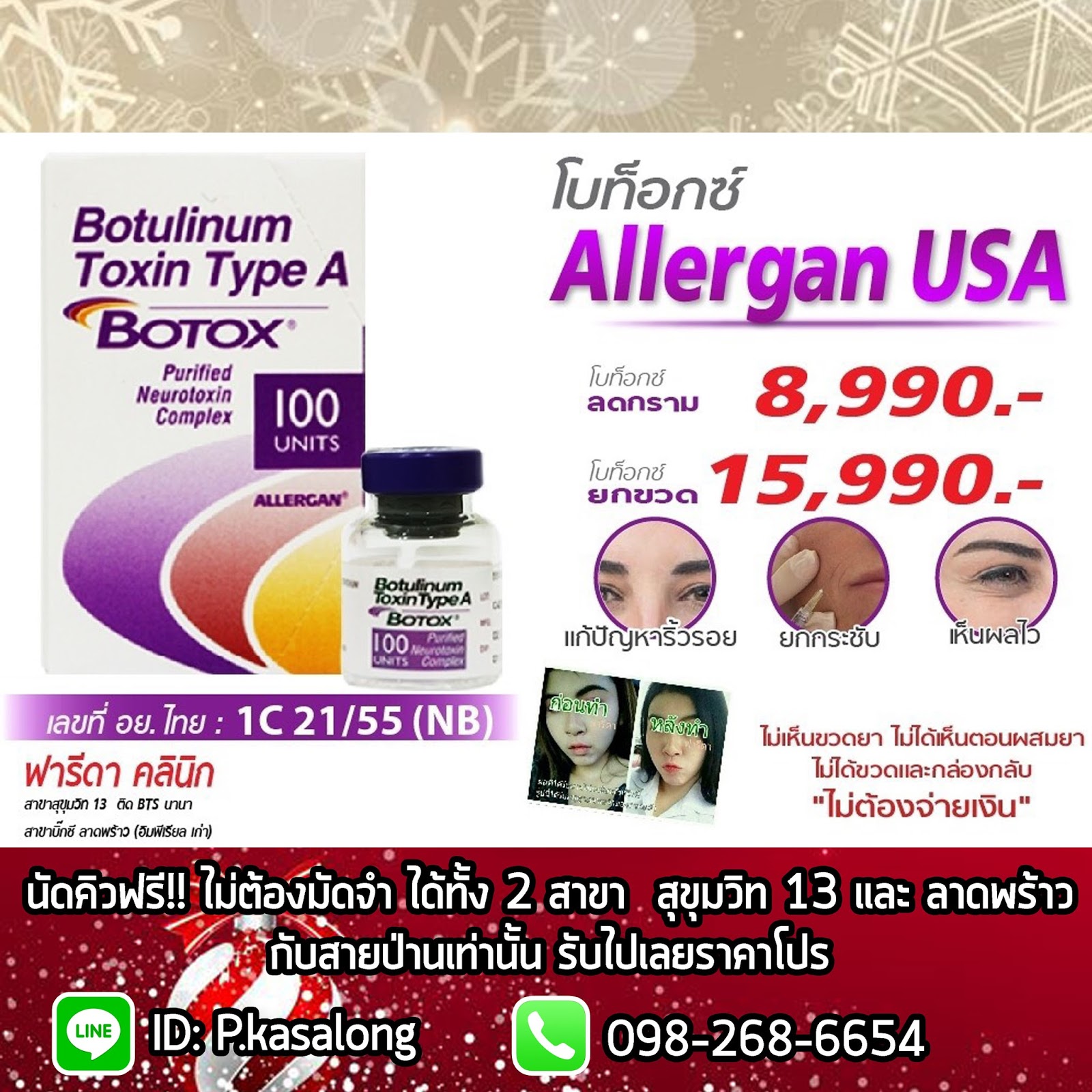 BOTOX Allergan 15,990.-/100 Unit (America) จองคิวกับสายป่าน Tel.098-268 ...
