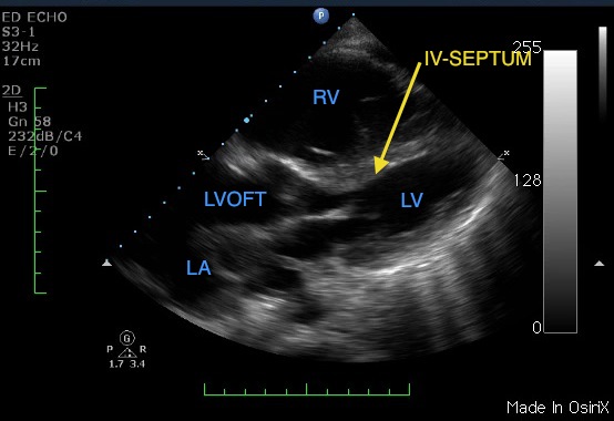 Right Heart Strain ~ Ultrasound Cases Info