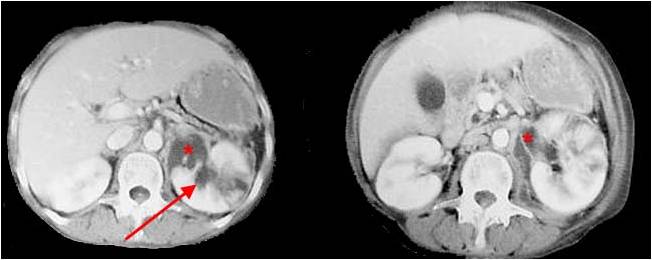 Abdominal Section: Renal abscess