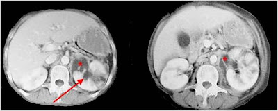 Radiologist For Ever: Renal rule 17 : Renal abscess