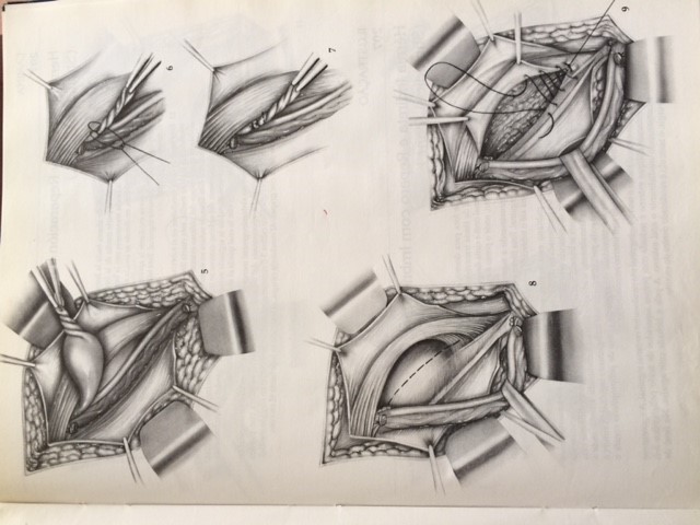 DR. JUAN HERNÁNDEZ ORDUÑA. : Plastia inguinal con tensión