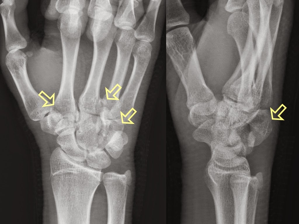 Chia-Wei Lin MD. | 林佳緯 醫師: Hamate fracture（鎚狀骨骨折）-- 手腕尺側易被忽略的骨折