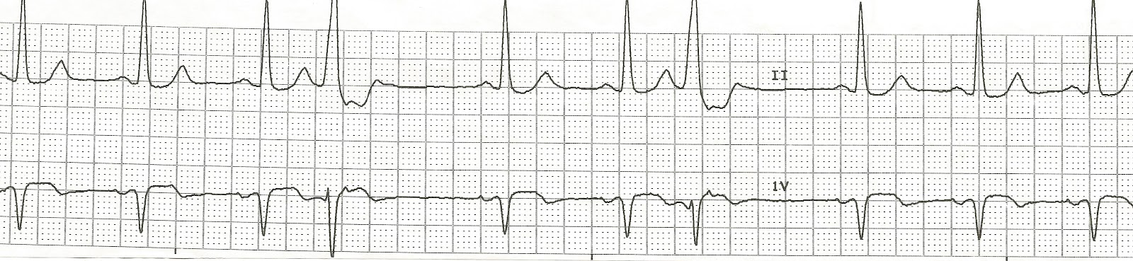 EKG Rhythm Strips 79