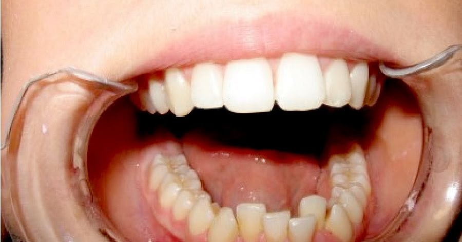 PDF: Angle Class I malocclusion treated with lower incisor extraction ...