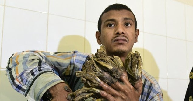 LOOK: “Tree man” needs 15 operations to get rid of his massive warts ...
