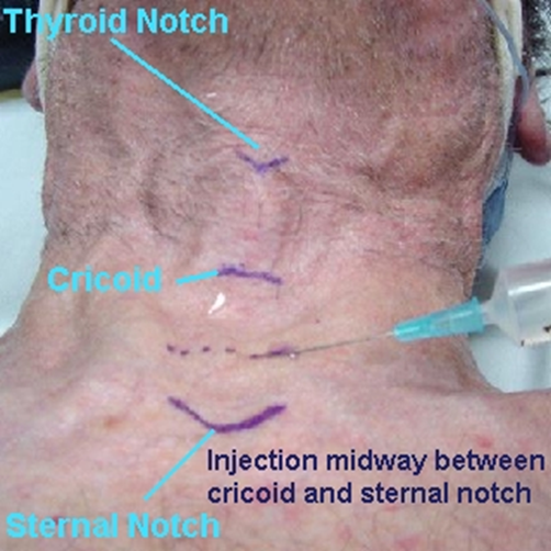Tracheotomy Care at home 1 ~ akufisio.blogspot