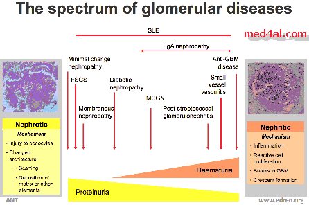 Glomerulonephritis definition , mechanism and clinical presentation ...