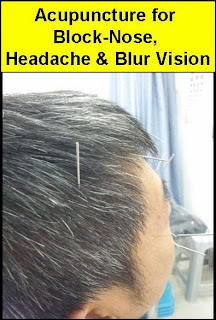 TCM News: TCM Block-Nose-triggered Headache, Blur Vision and Fluid ...