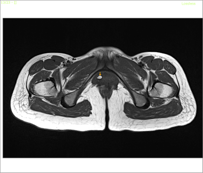mricases: Episiotomy scar endometriosis