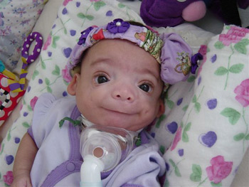 Angry Angry Guru: The OMENS => Treacher Collins Franceschetti Syndrome