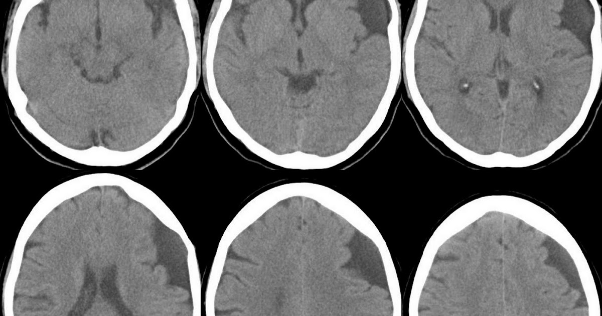 Dr Balaji Anvekar FRCR: Arachnoid cyst
