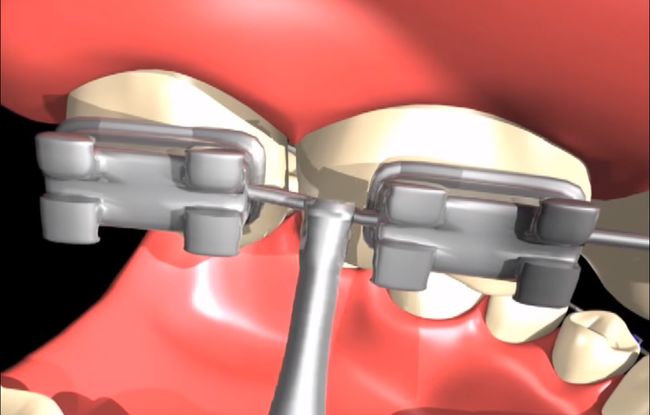 ORTHODONTICS advices : Loose Bracket - Directorio Odontológico