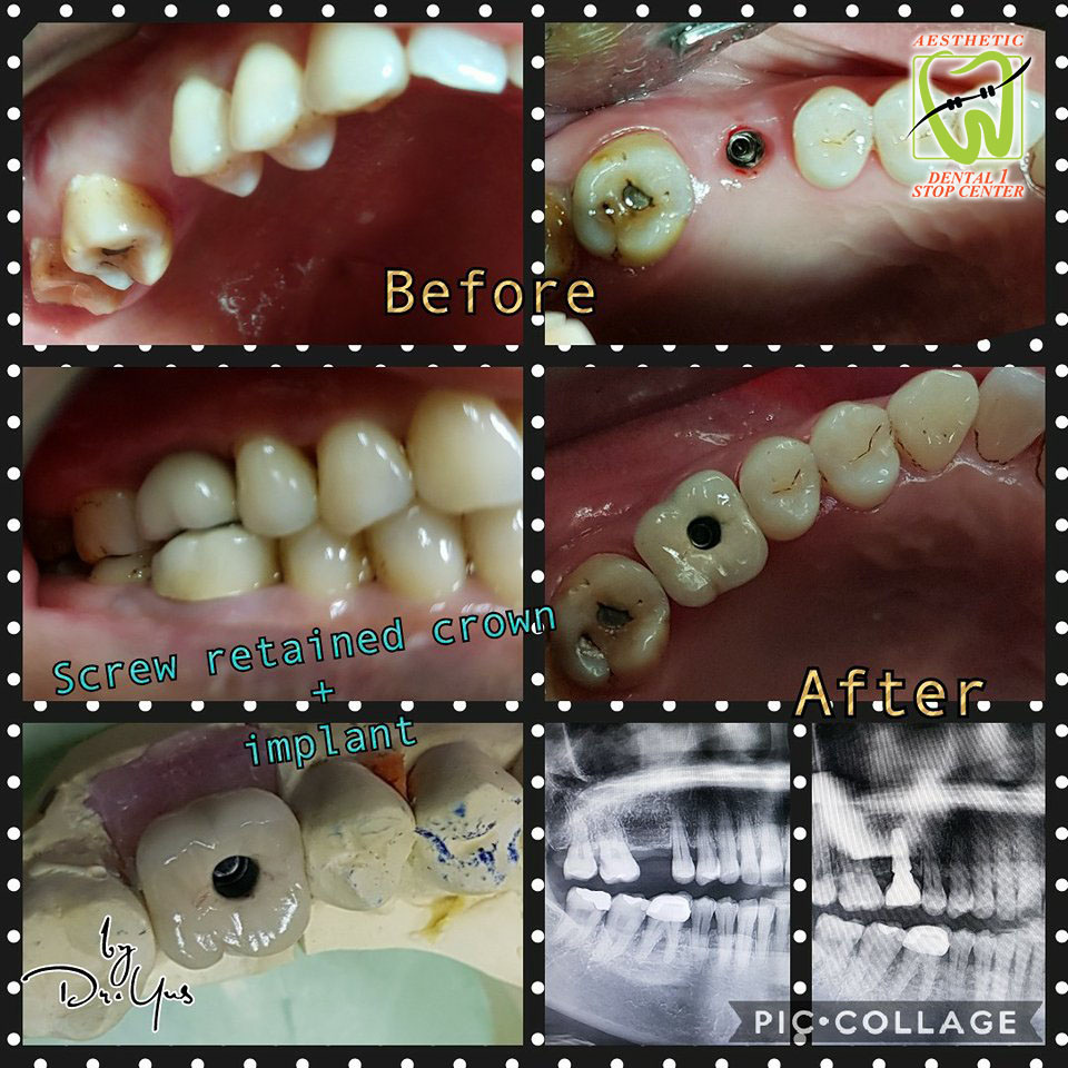 KLINIK PERGIGIAN SYARIFAH: Rawatan Implant di Klinik Kami