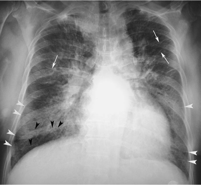 Manuali di Medicina Intensiva: Radiologia in ICU - quadri specifici ...