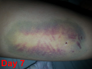 My experience with the birth control Implanon