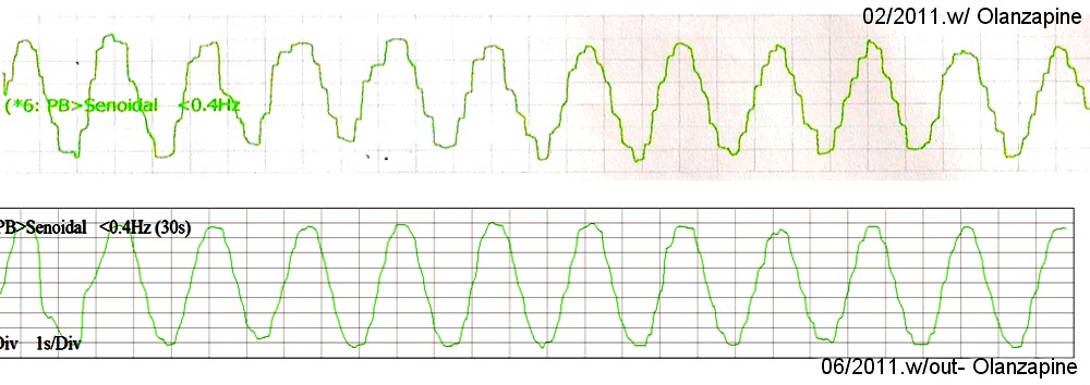 Neurociencias de la memoria y del equilibrio: ALTERACIONES OCULOMOTORAS ...