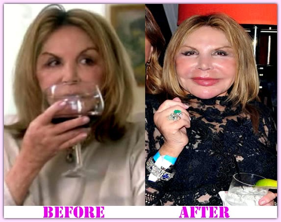 plasticsurgeryfeet: Elsa Patton Plastic Surgery – She Did Not See Her ...