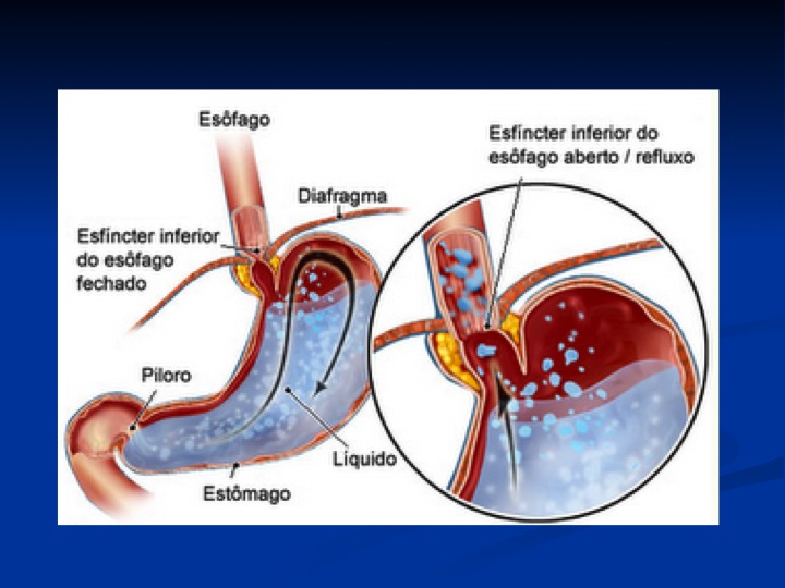 Gastroenterologia Pediátrica Niterói: AULA REFLUXO GASTRO-ESOFÁGICO E ...