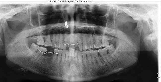 Dental Xray center in medavakkam: FRONT TEETH REPLACEMENT WITH NOBEL ...