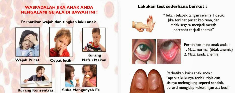 Anemia, sebagai akibat Defisiensi zat Besi (Fe) dan Seng (Zn)