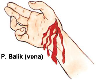 TNUMKS: mengetahuai apa itu pendarahan dan syok