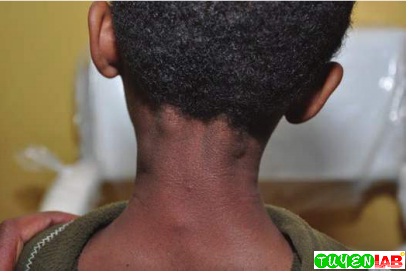 [Pediatric] Atlas of Lymphadenopathy | Free Medical Atlas