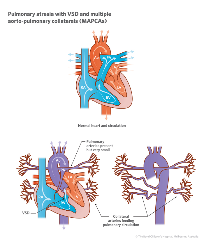 Are We Having Fun Yet?: Tetralogy of Fallot with Pulmonary Atresia ...