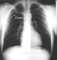 CUIDADOS DE ENFERMAGEM COM DRENO DE TORAX